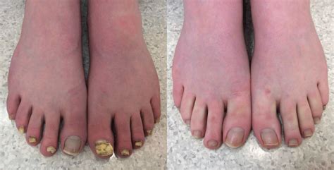 Toenail Fungus Before And After Toenail Fungus Before And After Photos