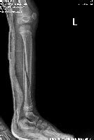 Bone Fracture Detection Object Detection Model By Fracture Detection