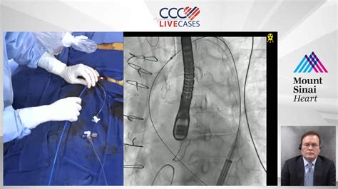 Corevalve Evolut R Tavr 26mm Via Percutaneous Femoral Access Aug 2015 Ccc Live Cases
