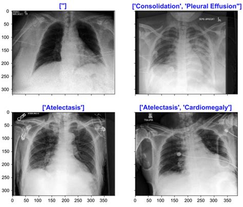 Data Science And Ai Info Multi Label Chest X Ray Classification Chexpert Data