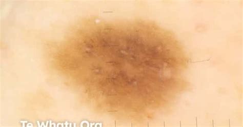 Melanocytic Naevus Image