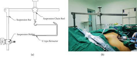 Figure 2 From Surgical Steps Of Gasless Transaxillary Endoscopic Thyroidectomy From A To Z