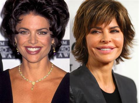 Did Lisa Rinna Undergo Plastic Surgery Including Lips And Botox