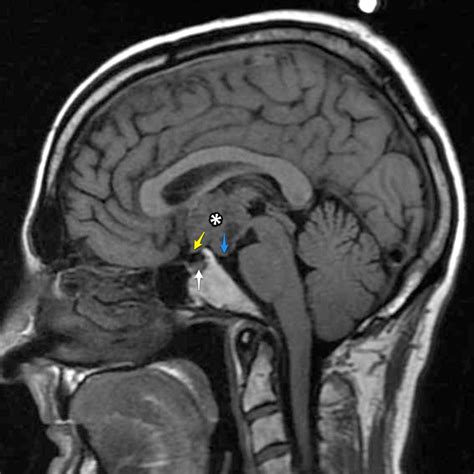 Third Ventricle Mri