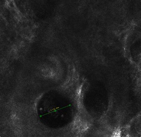 Type 2 Vascular Pattern At Rcm Evaluation Dilated Vessel With High Flow Download Scientific