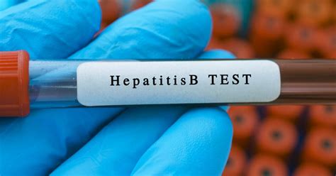 Researchers Team Up With Cdc To Expand Hepatitis B Screening Fsi