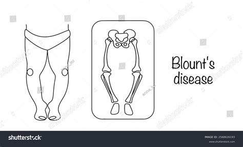 Proximal Tibia Deformity Internal Tibia Deformity Stock Vector Royalty