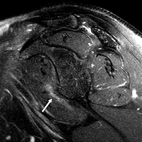 Adhesive Capsulitis Wiki At Matthew Mendelsohn Blog