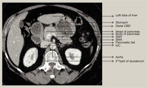 Radiological Anatomy Of The Abdomen Surgery Oxford International