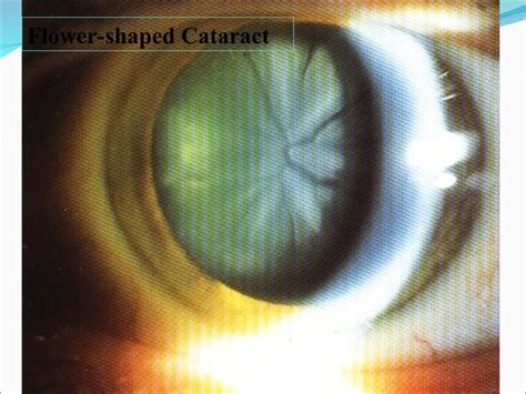 Cataract Types Pathophysiology And Treatment PPT Eye And Vision Conditions Diseases And