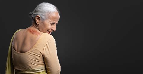Shingles Nagin Disease Akki Disease Symptoms Causes And Treatment