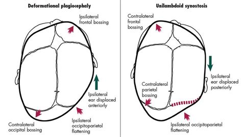 Figure 5 Deformational Plagiocephaly Left Can Be Easily Confused With Unilambdoid Synostosis