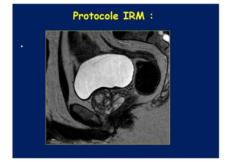 IRM prostatique