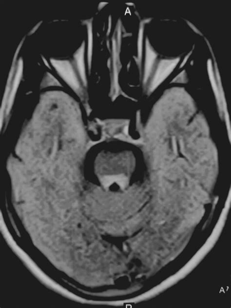 Flair Hyperintensity In The Dorsal Pons Download Scientific Diagram