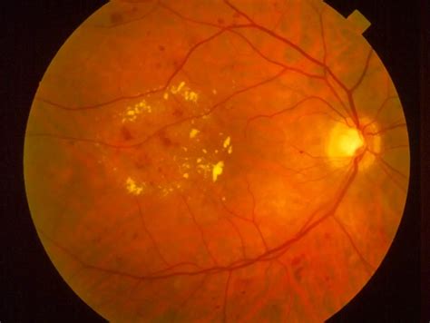 Diabetic Hard Exudates American Academy Of Ophthalmology