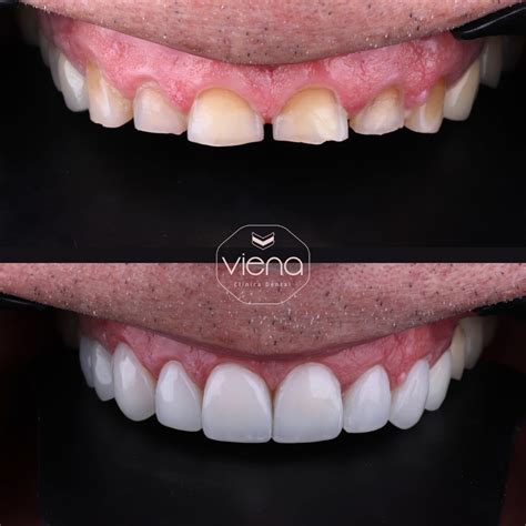 Incredible Composite Veneers Before And After Results