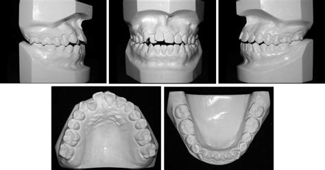 Glossectomy As An Adjunct To Correct An Open Bite Malocclusion With Shortened Maxillary Central