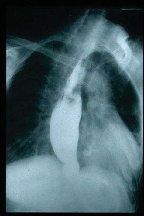 Scleroderma Esophagus