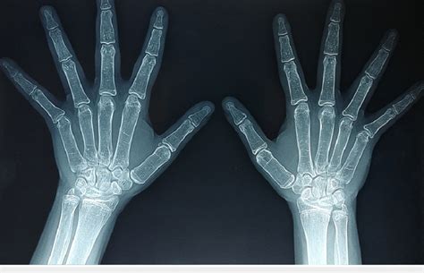 Bilateral Osteolysis At The Age Of 12 Download Scientific Diagram