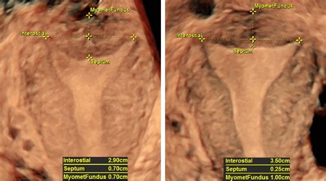 Intra Cycle Variation Of The Uterine Cavity Indentation Assessed With