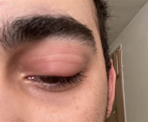 Random Eye Swelling Rallergy