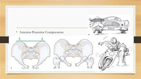 Pelvic Ring Injury Seminar 1 Pptx