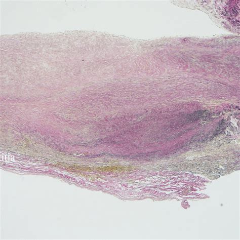 The Resected Left Circumflex Artery Branch Aneurysm Specimen Had A