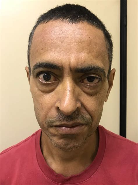 An Atypical And Interesting Feature Of Parkinson´s Disease Mds Abstracts