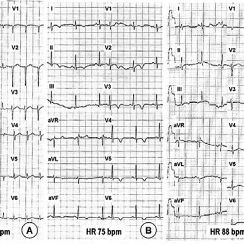 Echocardiogram Echo On Admission Showing Mild Hypokinesis Of Left Download Scientific Diagram