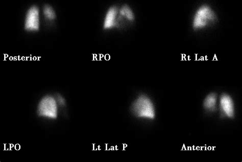 Radiation Dose Radiation Dose Vq Scan