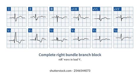 Intraventricular Block Photos And Images And Pictures Shutterstock