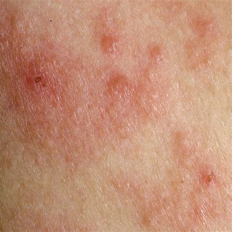 Causes Of Itchy Skin Rash