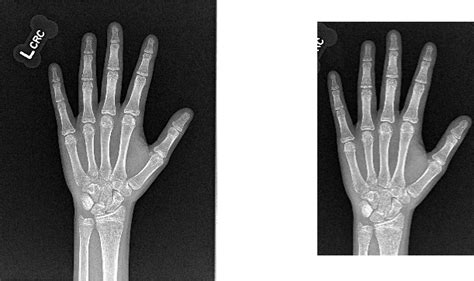 Ianpan Bone Age Crop · Hugging Face