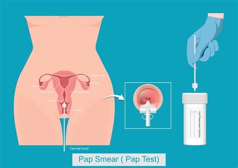 Cervical Smear Procedure Royalty Free Photos And Stock Images Shutterstock