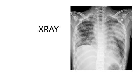 Small Vessel Vasculitis Case Presentation Ppt