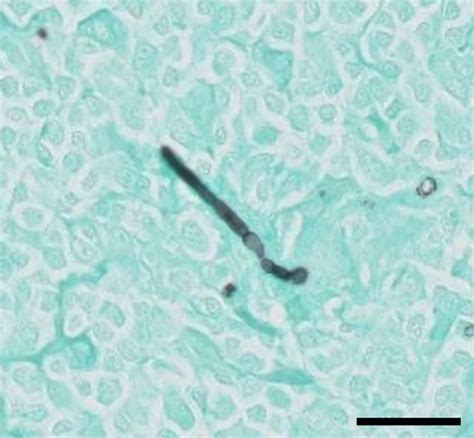 Left Popliteal Lymph Node Histopathology Reveals Occasional Septate Download Scientific Diagram