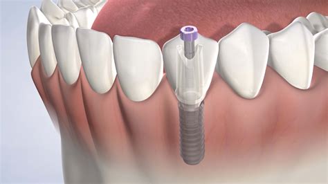 Post Operative Instructions Dental Implants At Oral Surgery