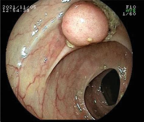 Figure 1 From Post Polypectomy Coagulation Syndrome A Tricky To