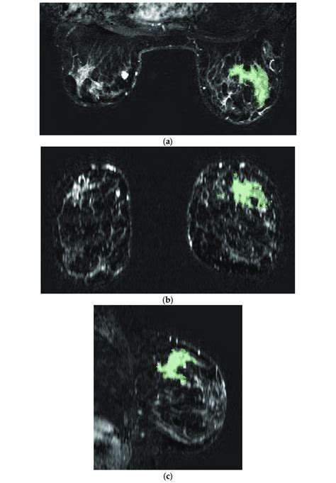 Tumor Lesion Segmentation Using 3d Slicer Software In Axial A