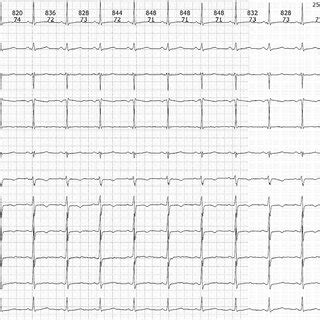 ECG After 1 Month Showed That Corrected QT Interval Had Returned To Normal Download