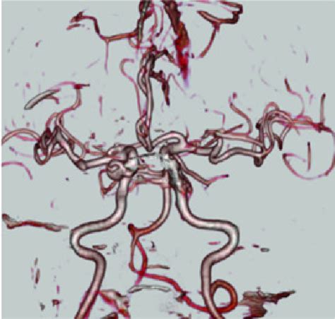 Brain Computerized Tomography Angiography Image With 3d Reconstruction Download Scientific