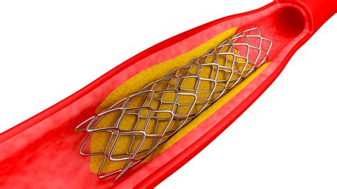 Angina Angioplasty Bypass Cad Heart Attack Stent Aopa