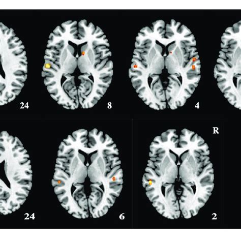 The Activation Likelihood Estimation Ale Maps Showing Significant Download Scientific