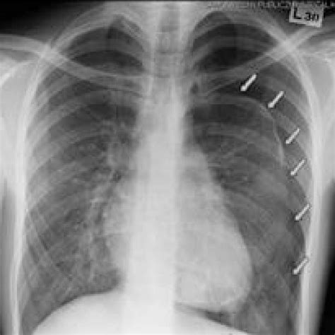 Two Dimensional Transthoracic Echocardiography Tte 2d Parasternal