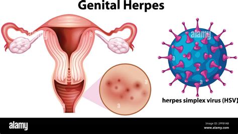 Genital Herpes With Herpes Simplex Virus Hsv Illustration Stock