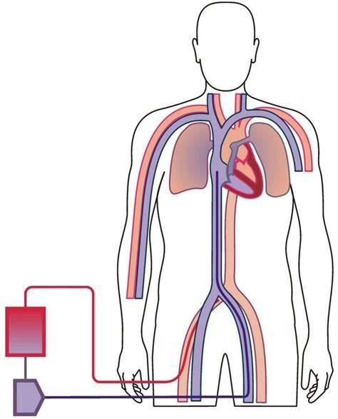 Configurations Of Ecmo Alfred Ecmo Guideline