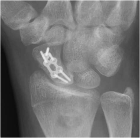 Rethinking Scaphoid Fixation Hand Clinics