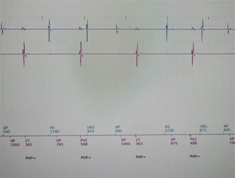 Remote Download Of Dual Chamber Pacemaker Recg