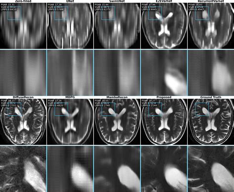 Next Acceleration Scale Prediction For Autoregressive Mri Reconstruction