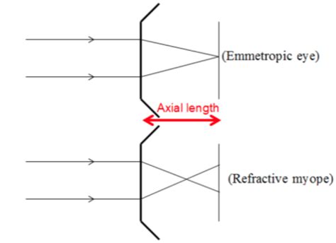 refractive errors flashcards quizlet